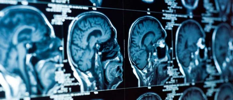 What is Wet Brain? Causes, Symptoms, and Treatment – Nova Recovery ...